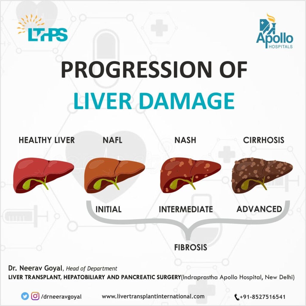 What Disqualifies You From A Liver Transplant | Dr Neerav Goyal