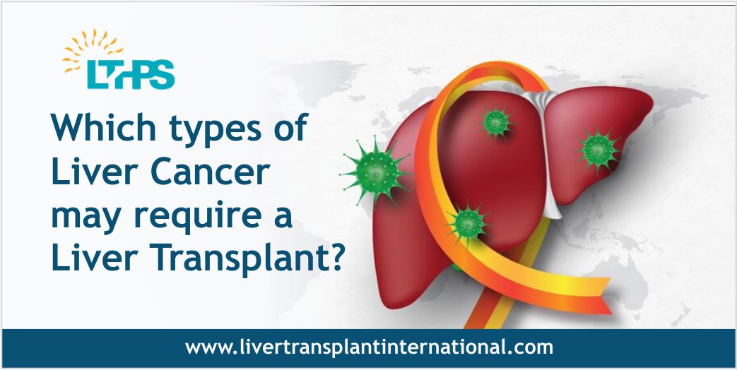 Which types of Liver Cancer may require a Liver Transplant? - Liver ...