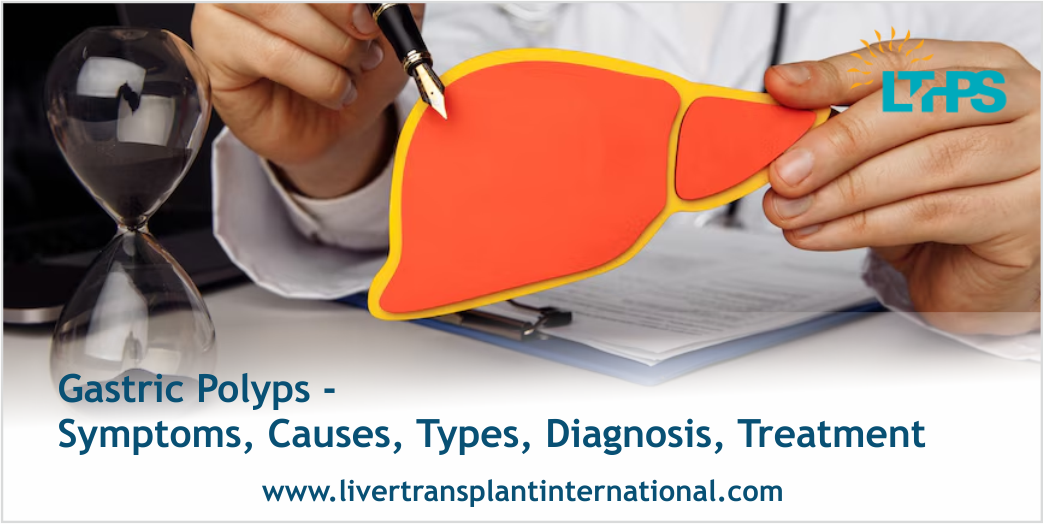 Gastric Polyps - Symptoms, Causes, Types, Diagnosis, Treatment