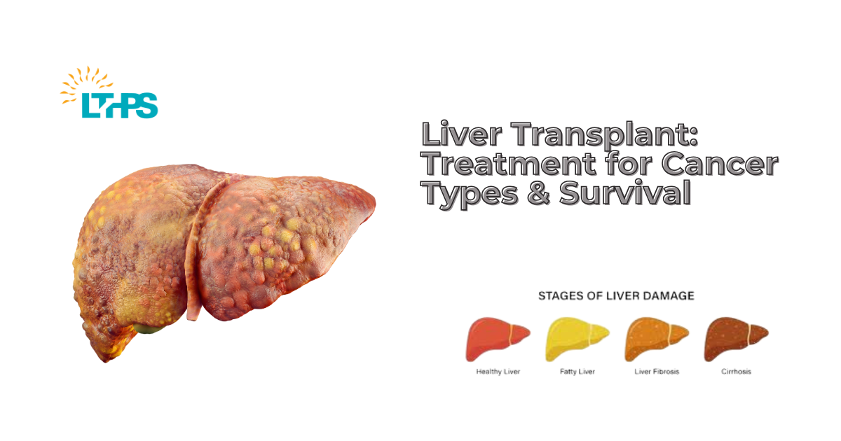 Liver Transplant: Treatment for Cancer Types & Survival - Liver ...