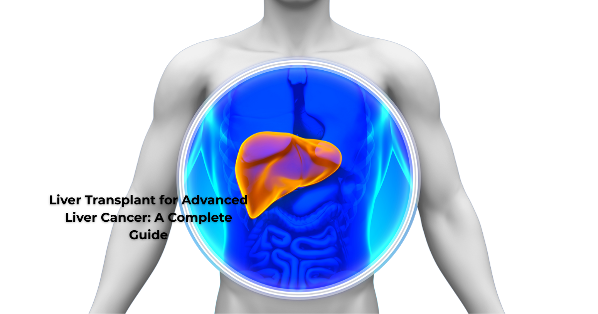 Liver Transplant for Advanced Liver Cancer: A Complete Guide
