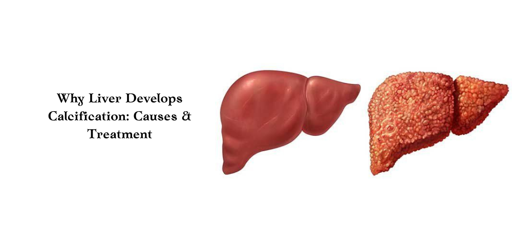 Why Liver Develops Calcification: Causes & Treatment